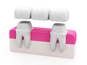 Dental Bridge: Treatment Procedure, Tooth Bridge Cost